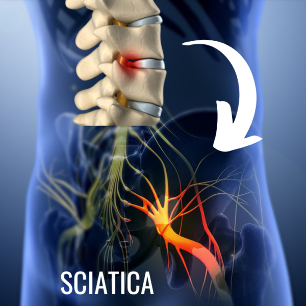 Disc Herniation / Sciatica Program - Better Movement